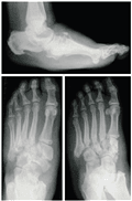 A Case of Diabetic Charcot Arthropathy of the Foot and Ankle