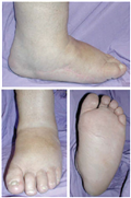 A Case of Diabetic Charcot Arthropathy of the Foot and Ankle