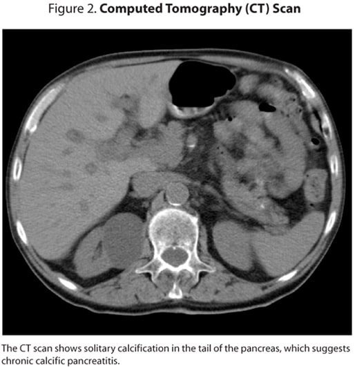 Evaluation and Diagnosis of Chronic Pancreatitis
