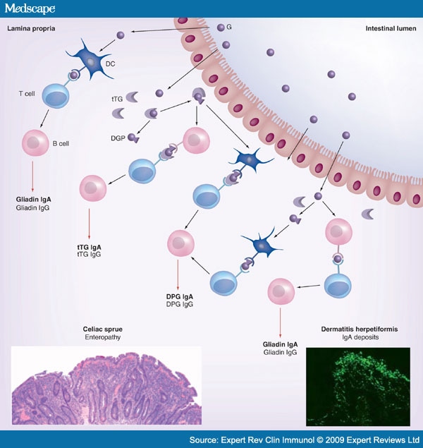 Celiac Sprue: a Unique Autoimmune Disorder