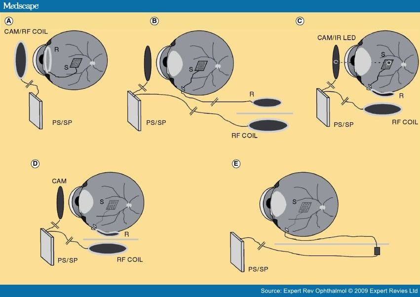 Implants for Artificial Vision - Page 2