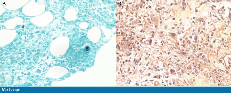 A Case of Indurated Skin Rash in a Transplant Patient - Page 3