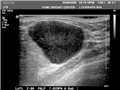 The Sonographic Findings and Differing Clinical Implications of Simple ...