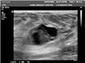 The Sonographic Findings and Differing Clinical Implications of Simple ...