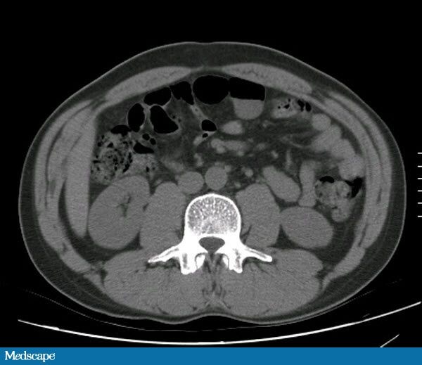 A 28-Year-Old Man With Mild-to-Moderate Ulcerative Colitis: Issues in ...