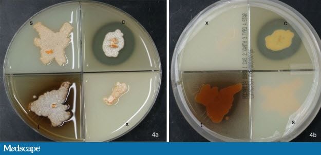 Microbiology of Ascending Lymphangitis - Page 2
