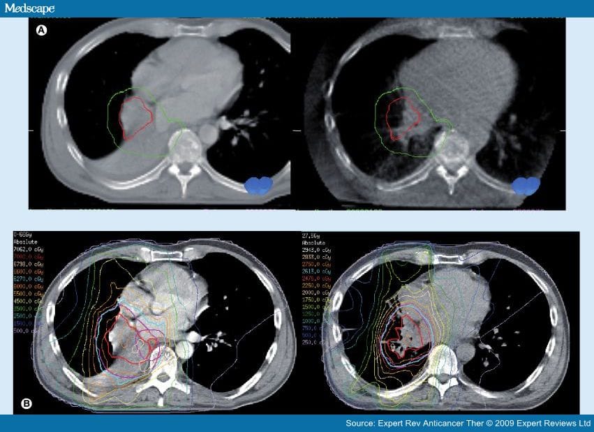 State-of-the-Art Lung Cancer Radiation Therapy - Page 5