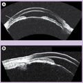 Anterior Segment Imaging for Assessment of Glaucoma