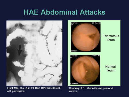 Hereditary Angioedema: Viewpoints From the Experts
