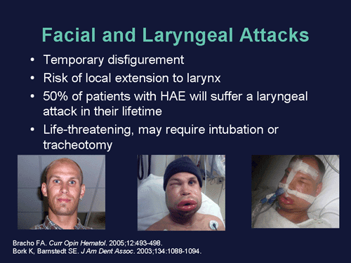Hereditary Angioedema: Viewpoints From the Experts