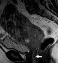 MRI and PET Scans for Primary Staging and Detection of Cervical Cancer ...
