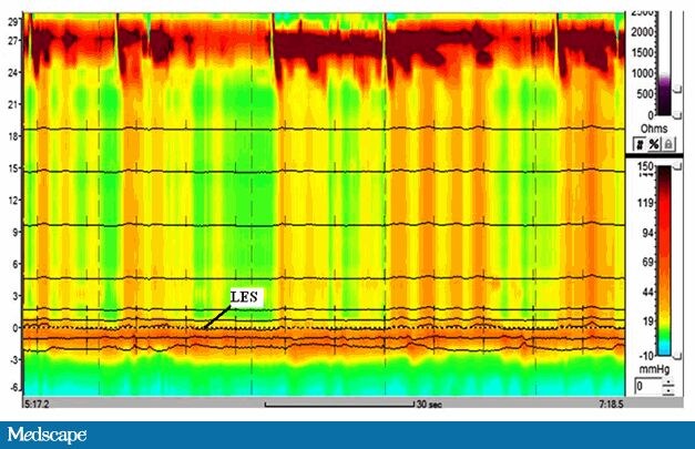 Achalasia: Heller Myotomy and Toupet Fundoplication - Page 4