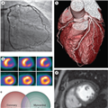 Integration of Coronary Anatomy and Myocardial Perfusion Imaging