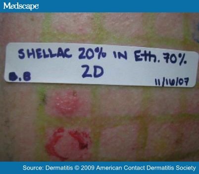 A Rare Eyelid Dermatitis Allergen: Shellac in a Popular Mascara - Page 4