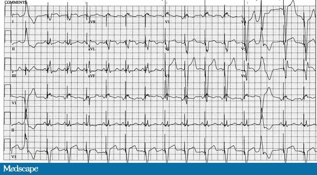 Ventricular Paced Complex: What's Your Diagnosis?