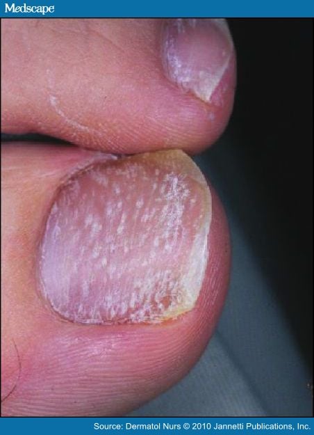 Nail Disorders in Children - Page 6