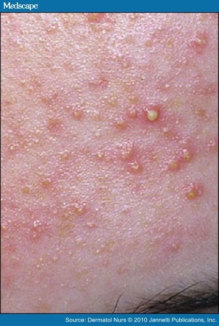 Case Review in Adolescent Acne: Multifactorial Considerations to ...