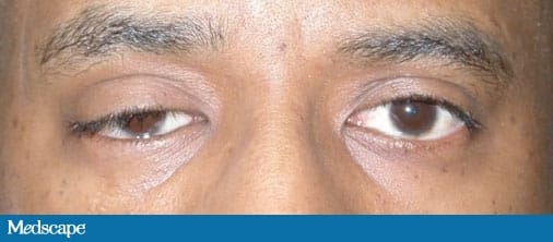 A 45-Year-Old Man With Chronic Discharge in an Anophthalmic Socket