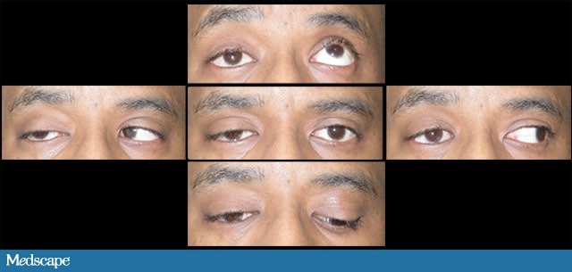A 45-Year-Old Man With Chronic Discharge in an Anophthalmic Socket