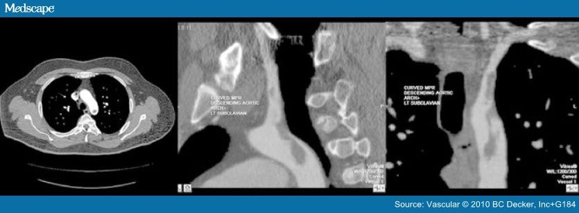 Symptomatic Thoracic Aorta Mural Thrombus - Page 2