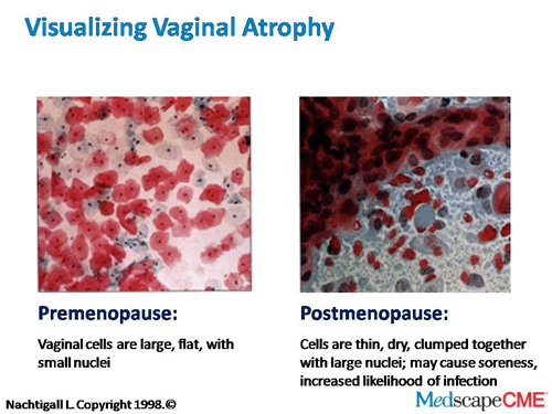 Addressing Vaginal Atrophy With Your Patients: Modifying an Existing ...
