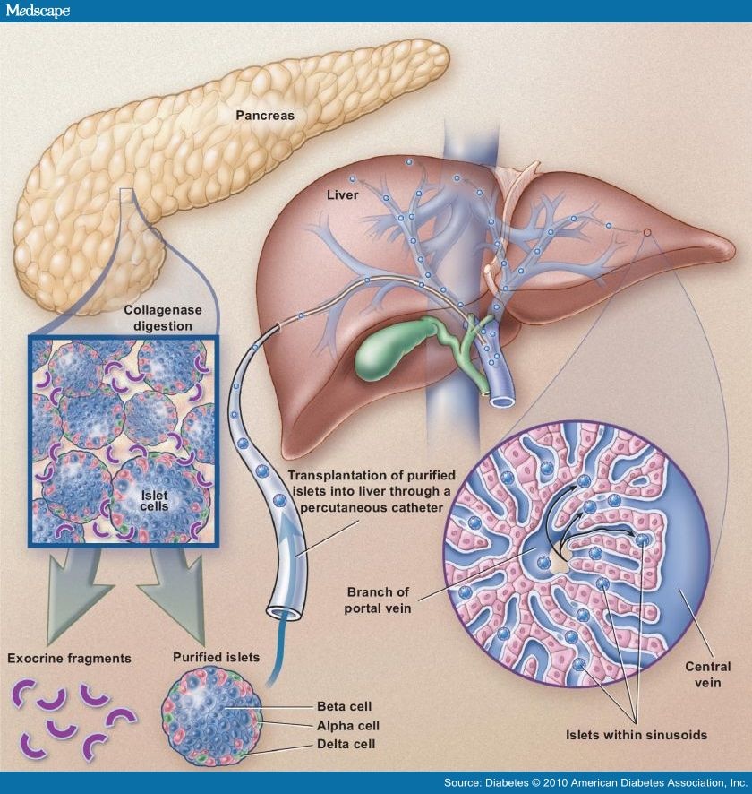 Islet Transplantation a Decade Later
