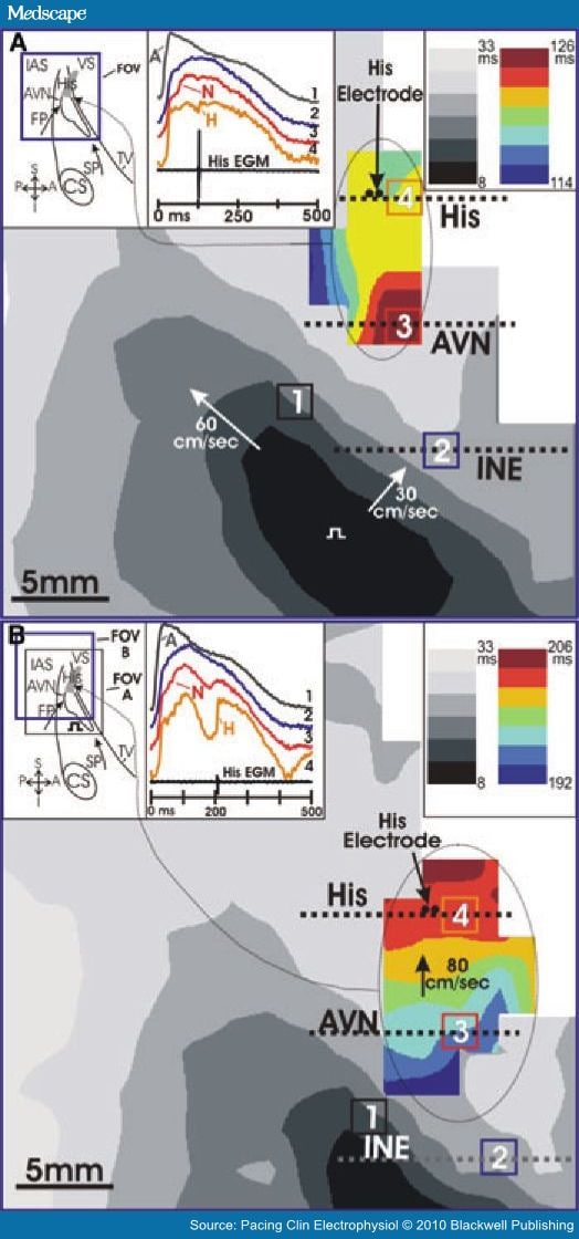 Anatomy and Electrophysiology of the Human AV Node - Page 3