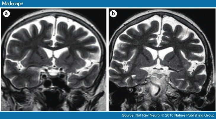 Frontotemporal Dementia Presenting as Pathological Gambling - Page 2