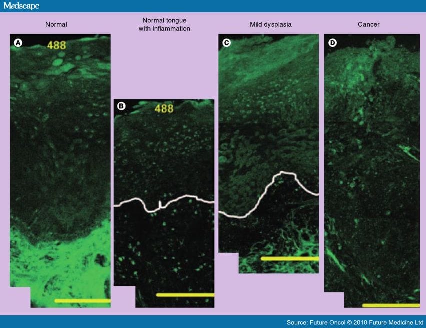 Advances in Fluorescence Imaging Techniques to Detect Oral Cancer - Page 2