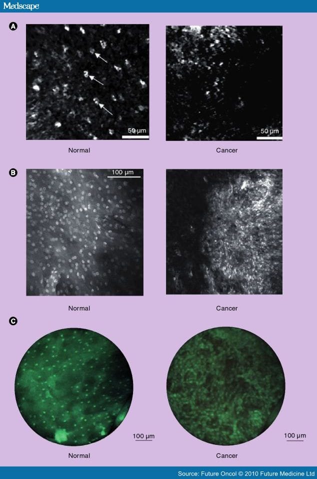 Advances in Fluorescence Imaging Techniques to Detect Oral Cancer - Page 2