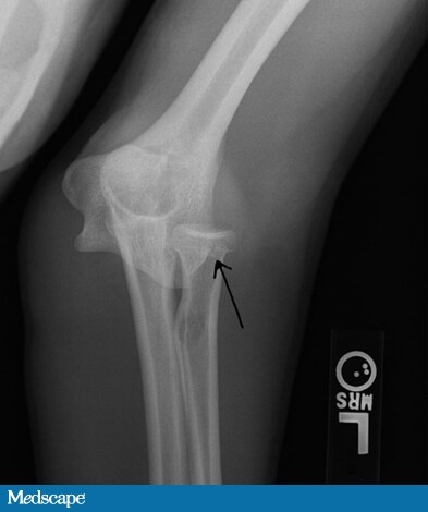Case Report: Elbow Dislocation in Active Duty Marine
