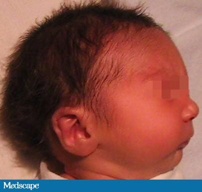 A Neonate With Dysmorphic Facial Features - Page 2