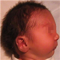 A Neonate With Dysmorphic Facial Features
