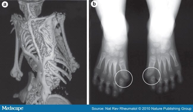 Fibrodysplasia Ossificans Progressiva X Ray