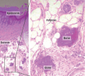 Heterotopic Bone Formation: Inherited Human Diseases
