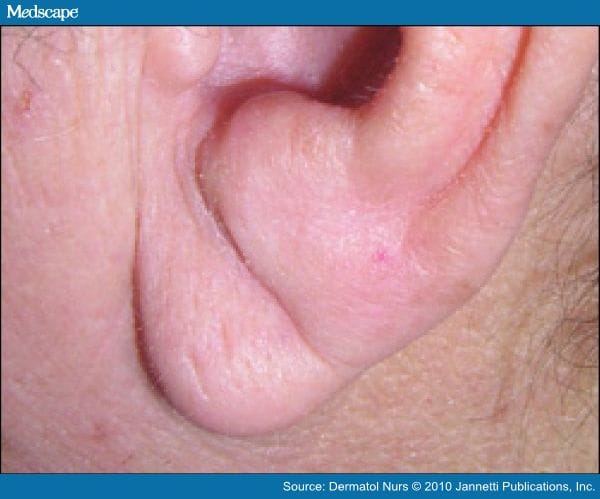 Internal Medicine and Dermatology: What's New? - Page 10
