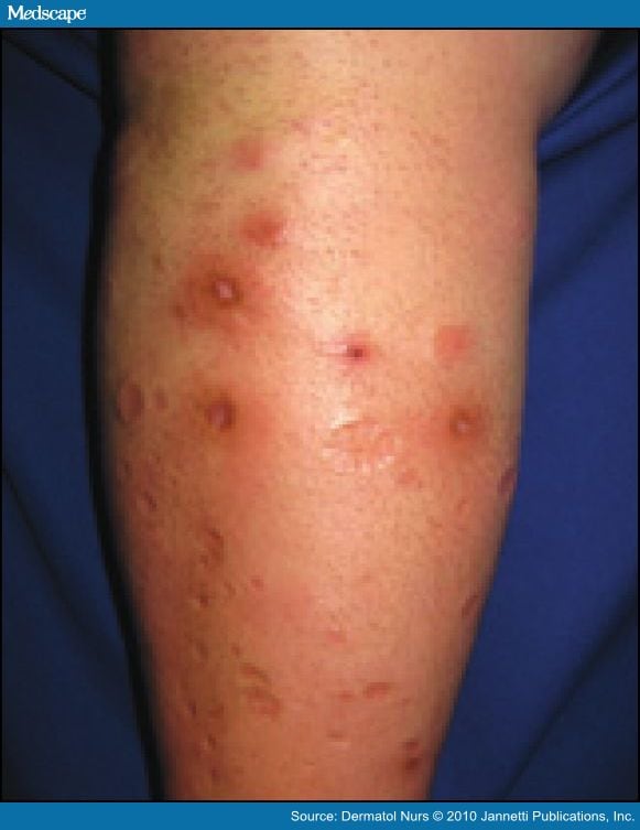 Internal Medicine and Dermatology: What's New? - Page 2