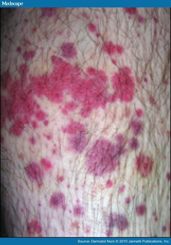 Internal Medicine and Dermatology: What's New? - Page 4