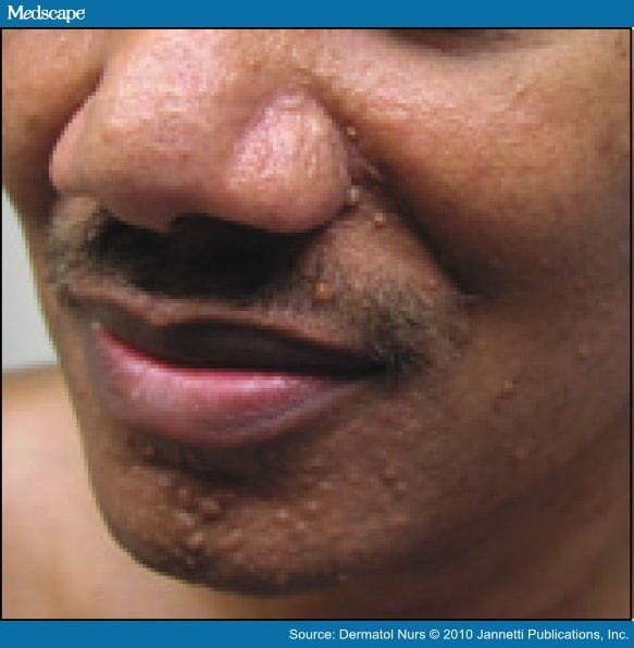 Internal Medicine and Dermatology: What's New? - Page 5