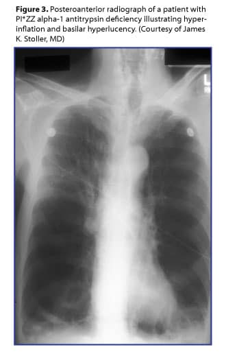 COPD and Alpha-1 Antitrypsin Deficiency: Early Identification