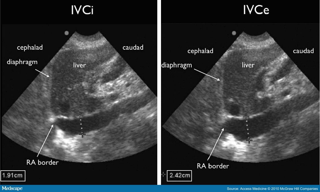 Ultrasound Assessment of CVP: Useful Tool or Wishful Thinking?
