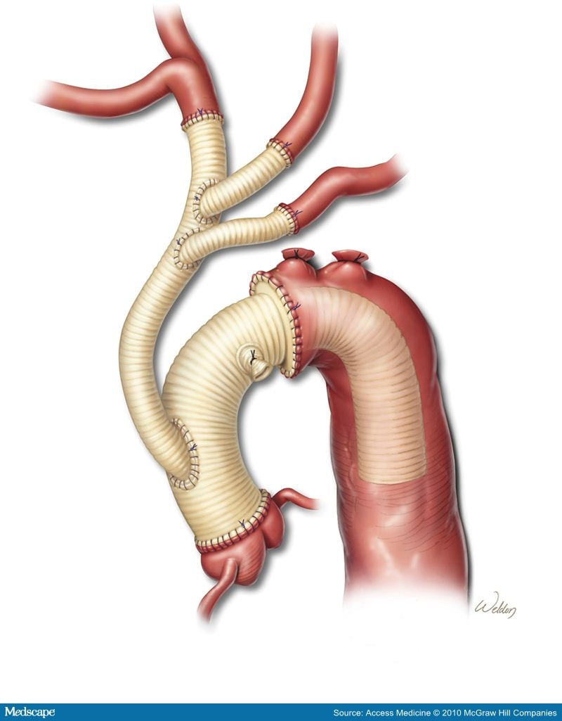 Aortic Dissections and Thoracic Aneurysms - An Update - Page 5