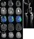 Imaging of Acute Stroke