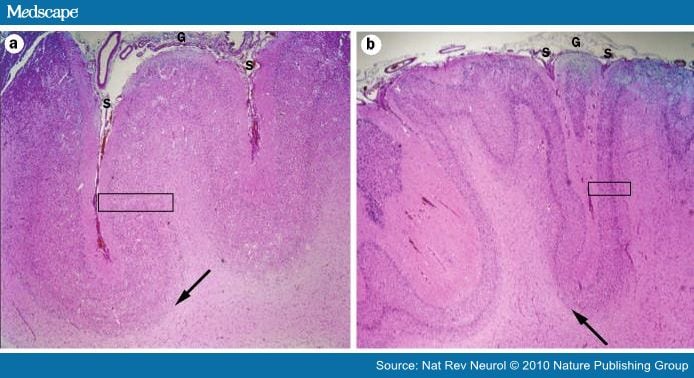 Cortical Malformations: Unfolding Polymicrogyria
