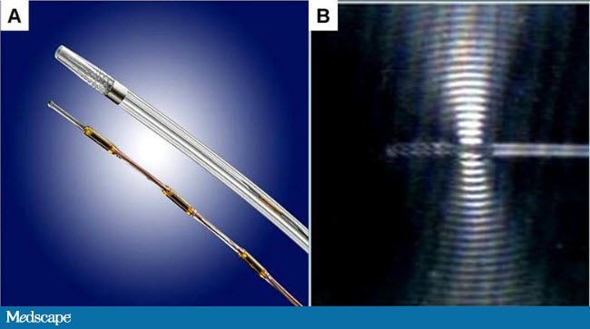 Endovascular Treatment for Acute Pulmonary Embolism
