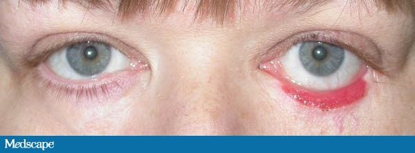 A 45-Year-Old Woman With a Mass on Her Eyelid