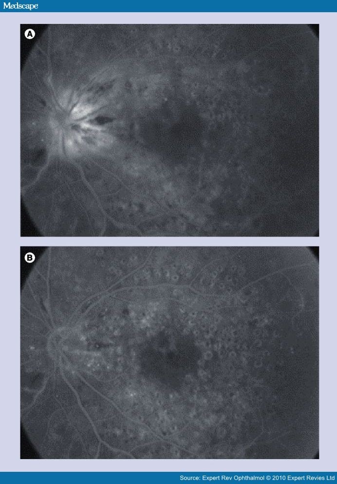 The Effects of Diabetes on Ocular Health: Comprehensive Review - Page 15