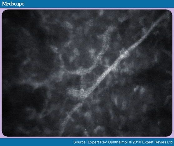 Mechanisms of Corneal Allergic Reaction: New Options for Treatment ...