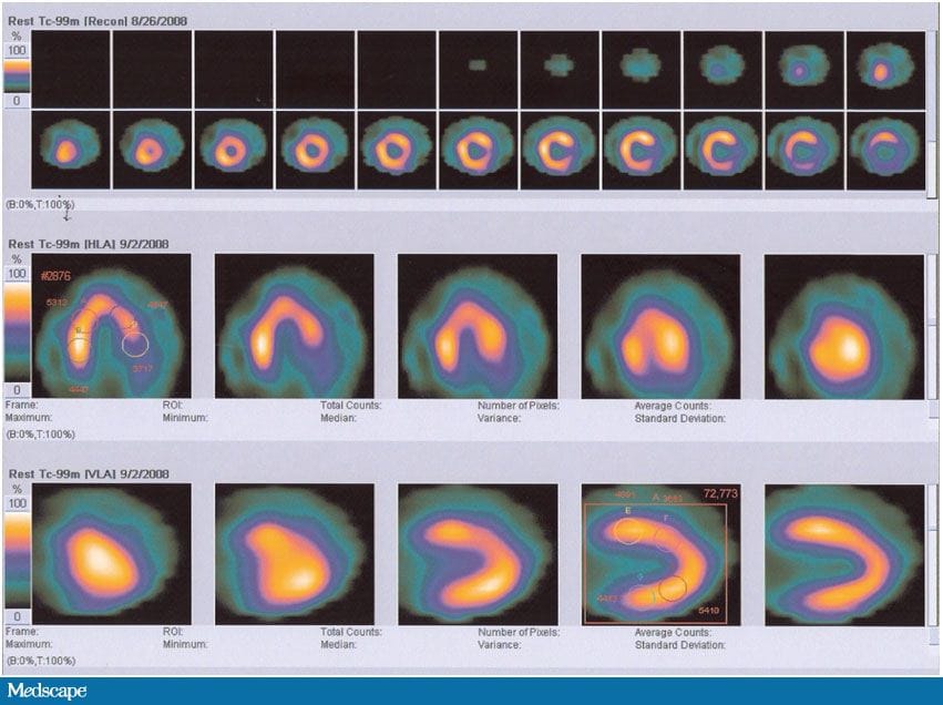 Sestamibi Kinetics May Distinguish Between Viable and Infarcted ...