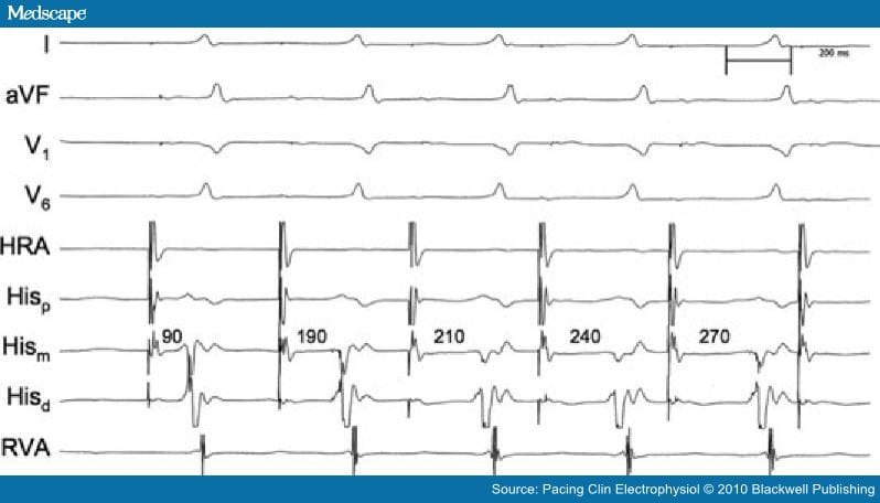 Delta Wave in Healthy Swiss Conscript: Don't Always Have to Burn to ...